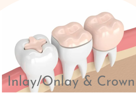 Onlays/Inlays – Nuala Cagney Dental